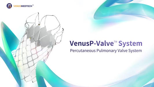 Venus Medtech VenusP-Valve transcatheter pulmonic valve replacement ...